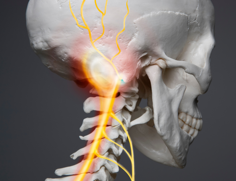 Occipital nerve block – KCA Neurology